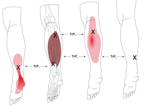 Tendinopathy / Tendonitis | Spine Plus